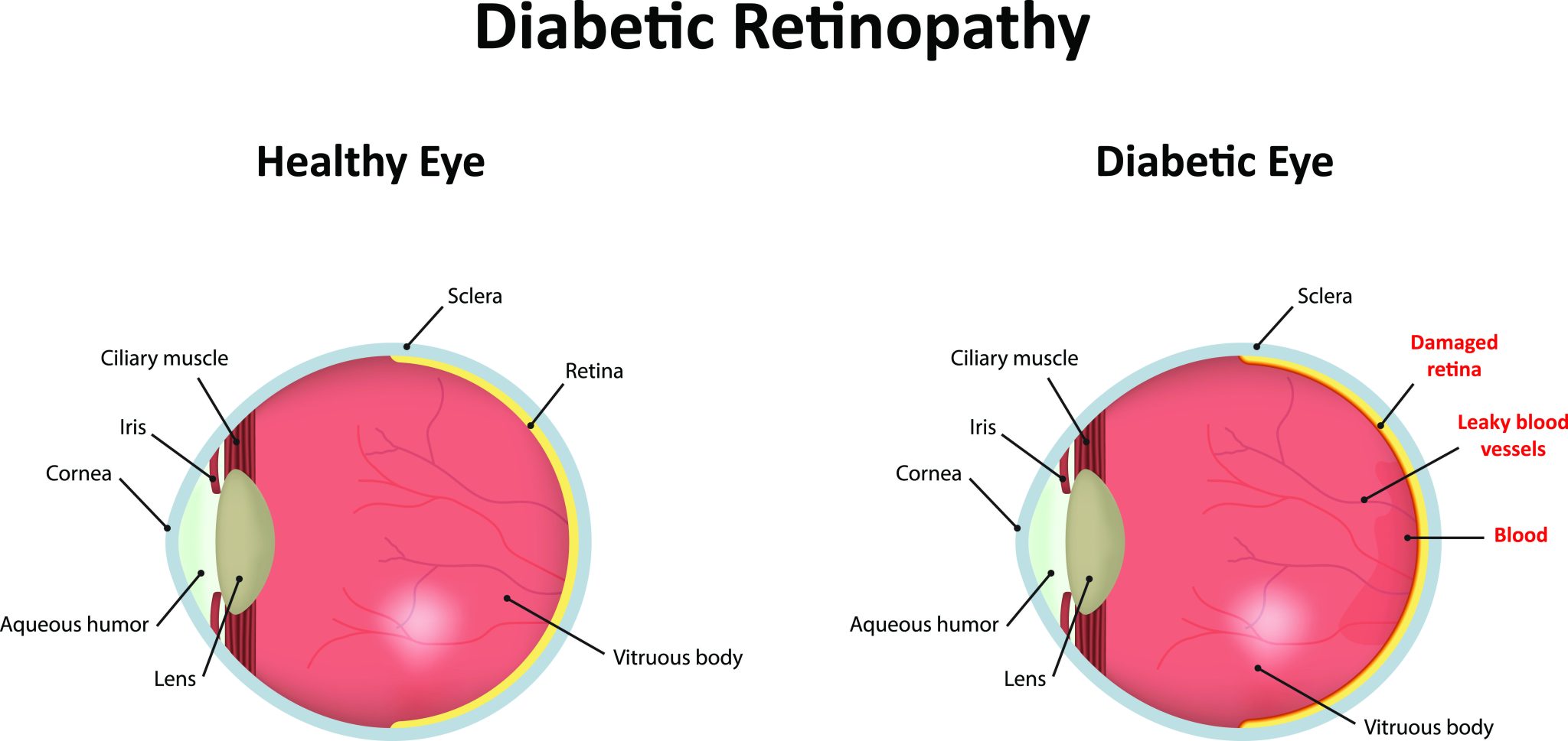 Diabetic Eye Disease: Retinopathy, Vision Loss | EYES Optometry - EYES ...